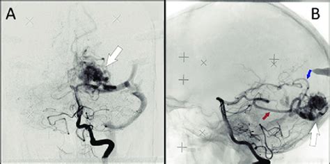 Left Vertebral Digital Subtraction Angiography Demonstrating A