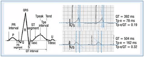 measurements of tp e interval and the tp e qt ratio please note the
