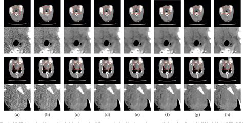 Figure From Low Dose CT Image Denoising Using Multi Level Feature Fusion Network And Edge