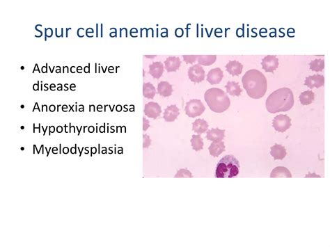 Hemolytic Anemia Case Pptx