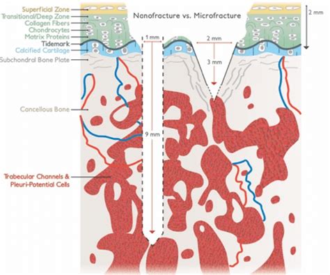 Comparison Of Microfracture To Nanofracture Considerations For Download Scientific Diagram