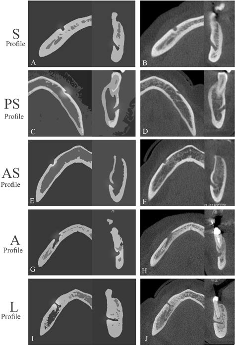 Figure 3 From The Mental Foramen Anatomical Parameters Through A