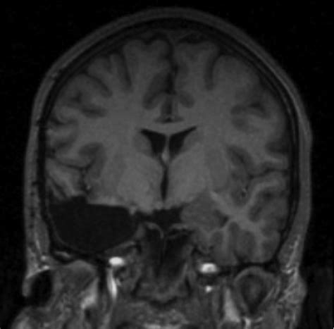 Mesial Temporal Lobe Anatomy