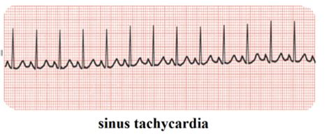 Cardiac Rhythms Flashcards Quizlet