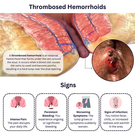 Top Signs Of A Thrombosed Hemorrhoid Vein And Endovascular Medical Care