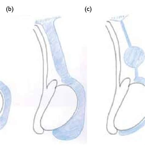 Torsion And Testicular Appendage Torsion Of A Testicular Appendix Download Scientific Diagram