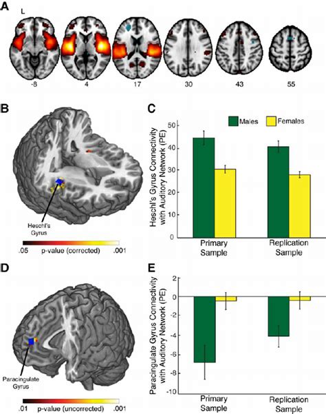 Bidirectional Sex Differences In Connectivity With Auditory Rsn