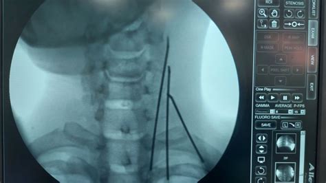 Anurag Agarwal On Linkedin Radiofrequency Of Cervical Medial Branches Is Always A Gratifying…