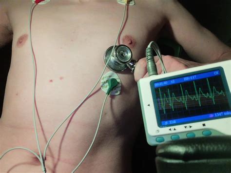 Fast Heart Sound After Exercise With Ecg