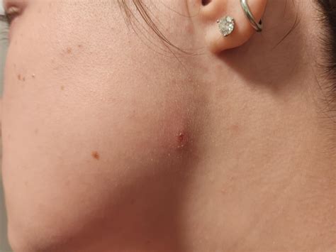 Ringworm Vs Staphimpetigo Rdermatologyquestions