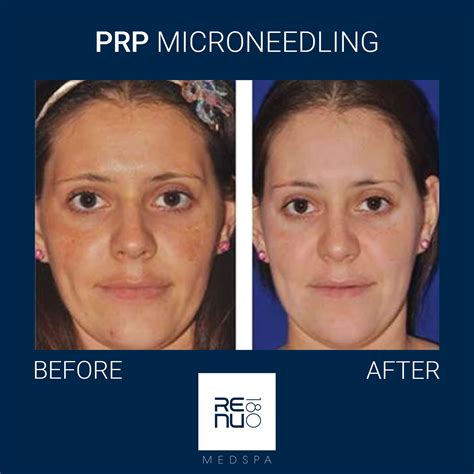 Before And After Gallery Prp Microneedling Re Nu 180 Medspa
