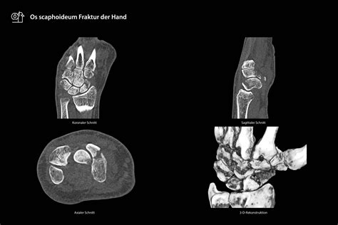 Perspektive Scs „fallvorstellung Os Scaphoideum Fraktur Der Hand“ Scs