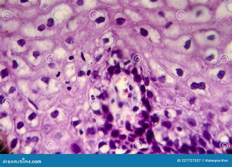 Cancer Of Cervix Light Micrograph Of Cervical Biopsy Stock Image
