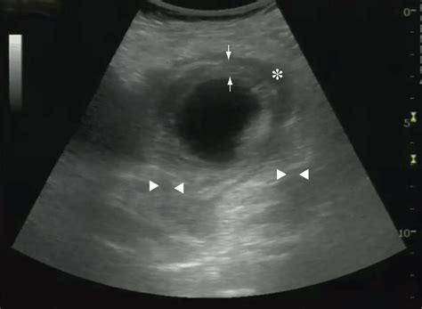 Pericholecystic Fluid On Ultrasound