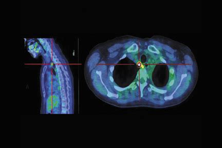 FDG PET CT For Planning Of Radiation Therapy Applied Radiology