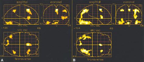 Statistical Parametric Map Of The T Statistic After Transformation To Download Scientific