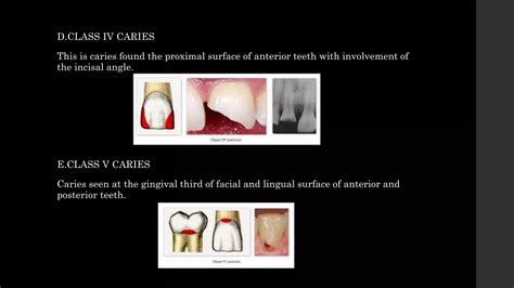 Dental Caries Classification And Microbiology Pptx