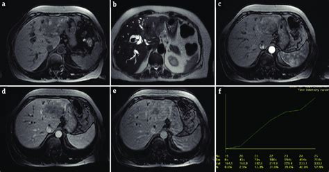 A F Intrahepatic Cholangiocarcinoma Mass Forming Ihcc Is Seen Is