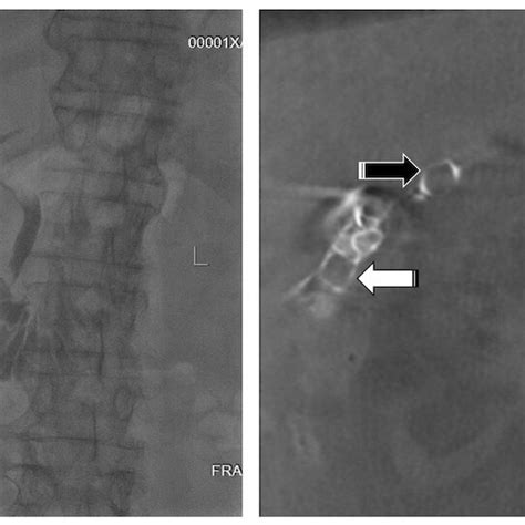 Pdf Percutaneous Endoscopy Peritoneoscopy And Lithotripsy For
