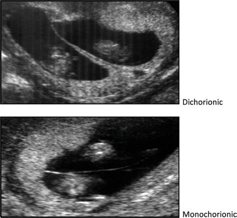 T Sign In Usg Feature Of Dichorionic Diamniotic Twin