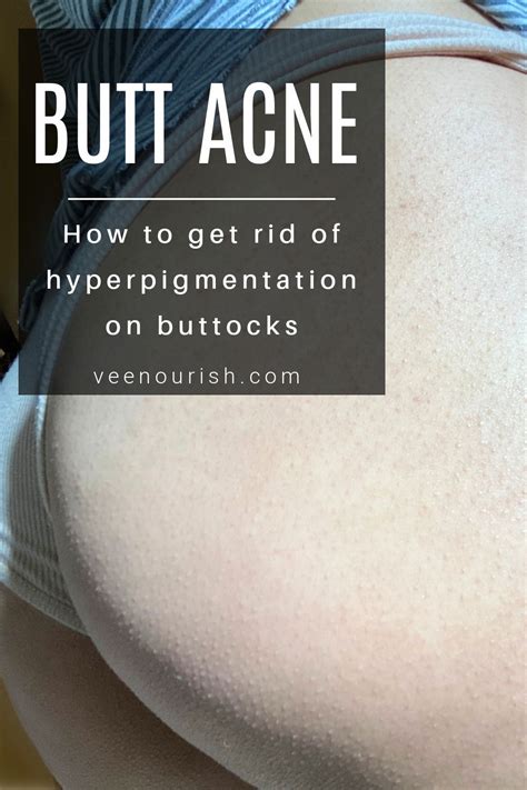 Butt Pimples What Causes Butt Acne And How To Get Rid Of It Artofit
