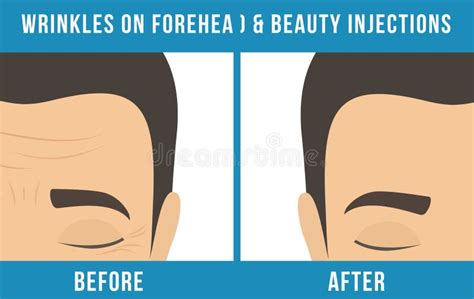 Botox Injection Stock Illustrations Botox Injection Stock Illustrations Vectors Clipart