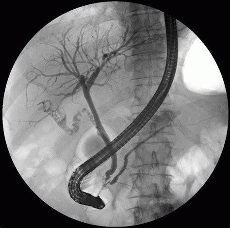 Biliary Strictures Bile Duct Narrowing Healthhype