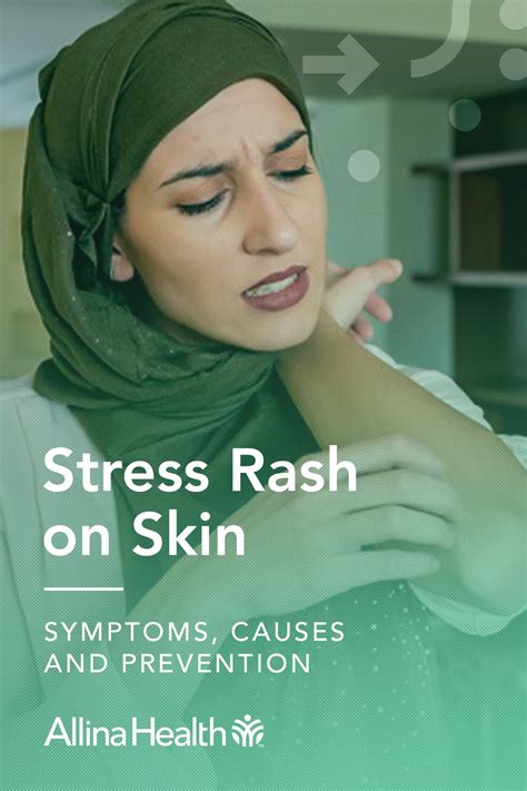 Stress Rash Causes Symptoms And Treatment Artofit