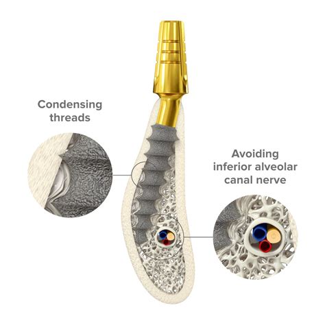 One Piece Implants Cortically Fixed Academy