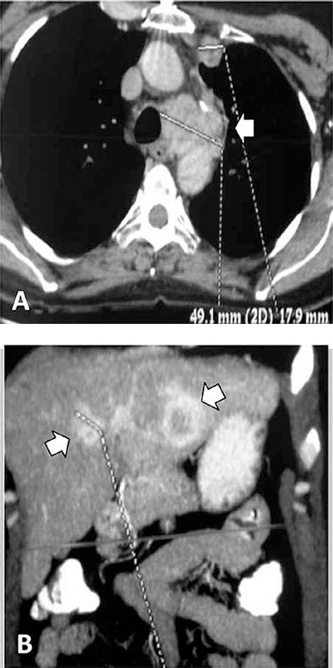 Rapid Response Of Hypercortisolism To Vandetanib Treatment In A Patient With Advanced Medullary