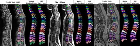 Figure 1 From Denoising Diffusion Based Mr To Ct Image Translation Enables Whole Spine Vertebral
