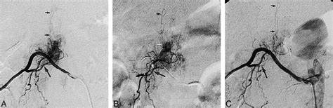 Figure 2 From Preoperative Transarterial Embolization Of Spinal Tumor