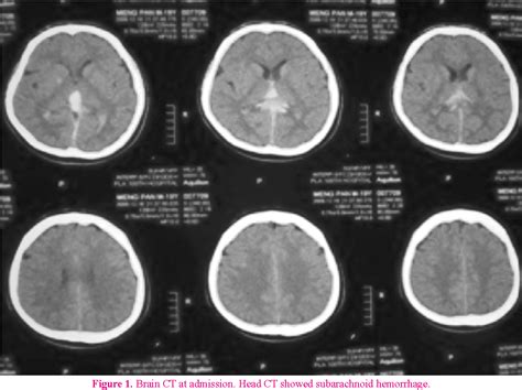 Figure 1 From Treatment Of Vitamin K Dependent Coagulation Factor Deficiency And Subarachnoid