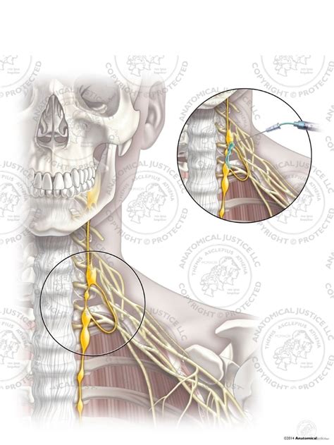 Female Left Stellate Ganglion Block No Text