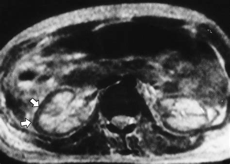Atypical Low Signal Intensity Renal Parenchyma Causes And