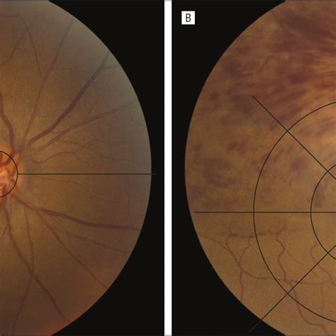 Evaluation Of Area Of Capillary Nonperfusion Early Phase Images A
