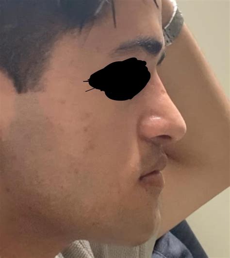 Maxilla Surgery Rjawsurgery