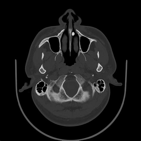 Supernumerary Ectopic Tooth Image