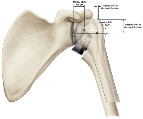 What S The Difference Between A Shoulder Replacement And A Reverse