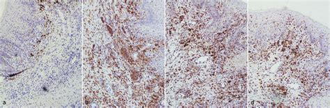 Ihc Stains Of Skin Biopsy × 100 Magnification A Alk Negative B