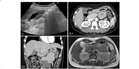 A Us Image Showing A Mass In The Gallbladder B 1 Cect Scan Image