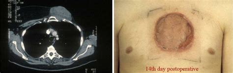 High Grade Sarcoma Of The Anterior Chest Wall Treated By Anterior Chest