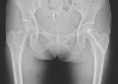 Hip Core Decompression Surgery Hip Preservation Treatment Manhattan