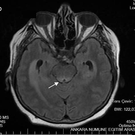 A Mri Signs Of Periphery Of Aqueductus Sylvii At Admission B Mri