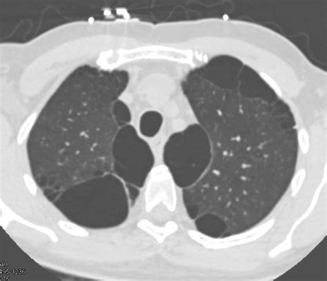 Chest X Ray Bullous Emphysema At Brock Hyland Blog