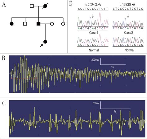Mutations Of SCN A Gene Cause Different Diseases Case Reports And Literature Review