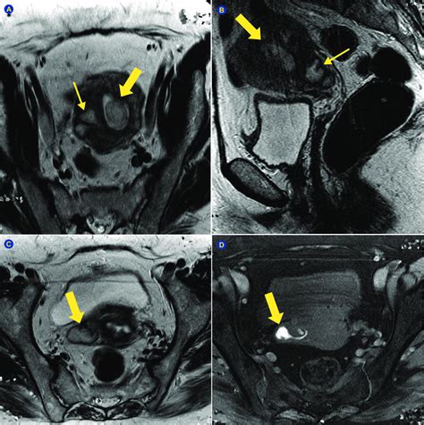 Pelvic Mri A Axial T2 Wi Shows A Polypoid Lesion In The Uterine Download Scientific Diagram