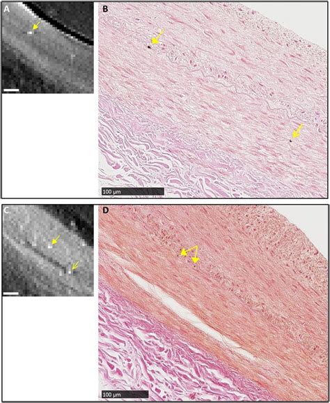 Two Instances Of Un Correlated Finds Of Micro Calcifications In The