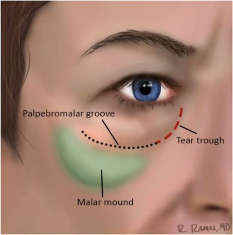Blepharoplasty Clinics In Plastic Surgery