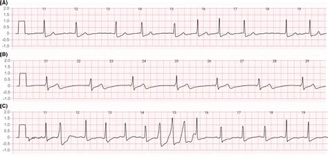 The Efficacy Of Detecting Arrhythmia Is Higher With 7‐day Continuous